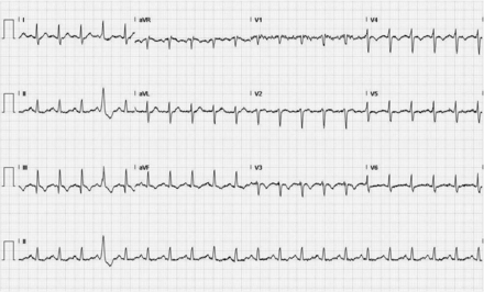 S1Q3T3 pattern leading to early diagnosis of pulmonary embolism | BMJ ...