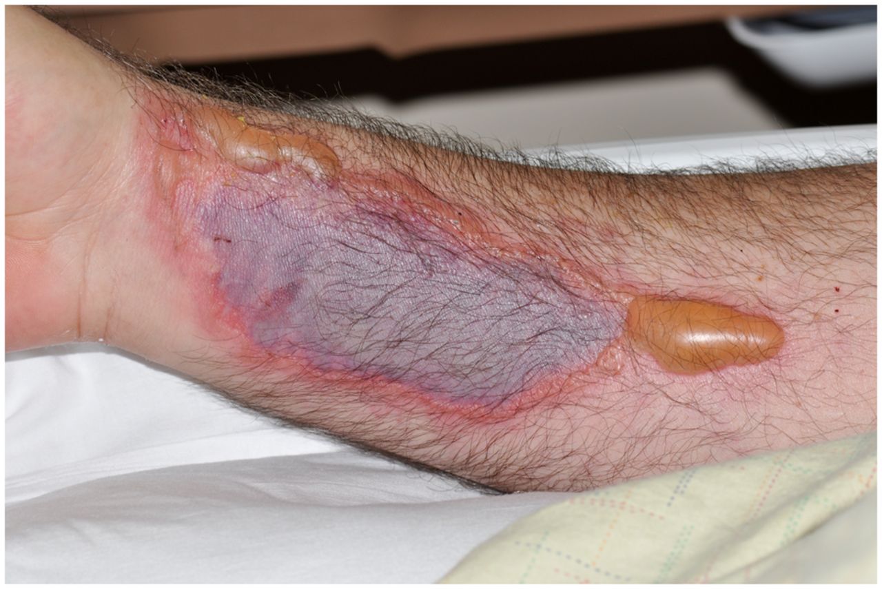 Well recognised but still overlooked: norepinephrine extravasation ...