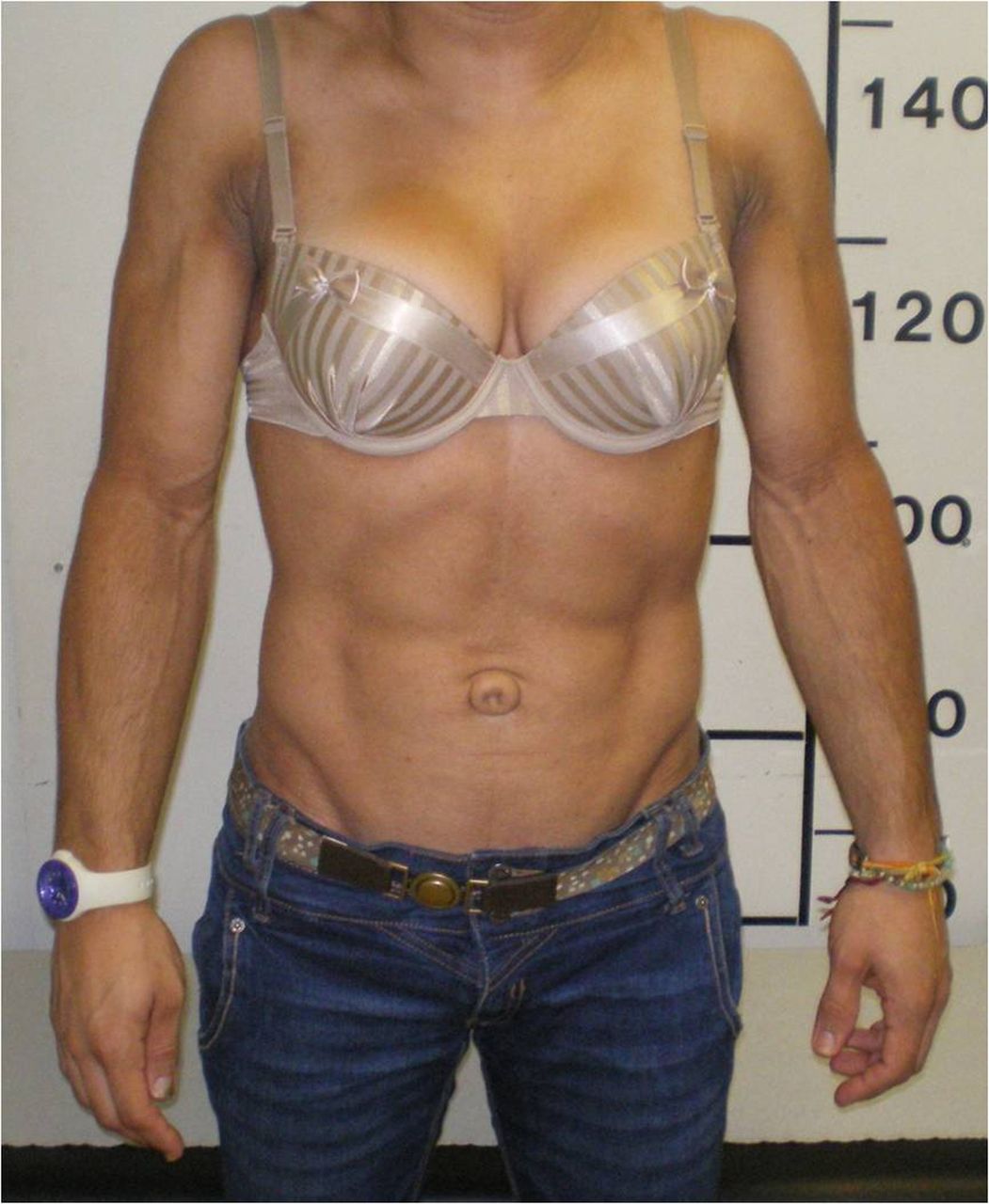 Berardinelli–Seip syndrome: highlight of treatment challenge | BMJ Case ...