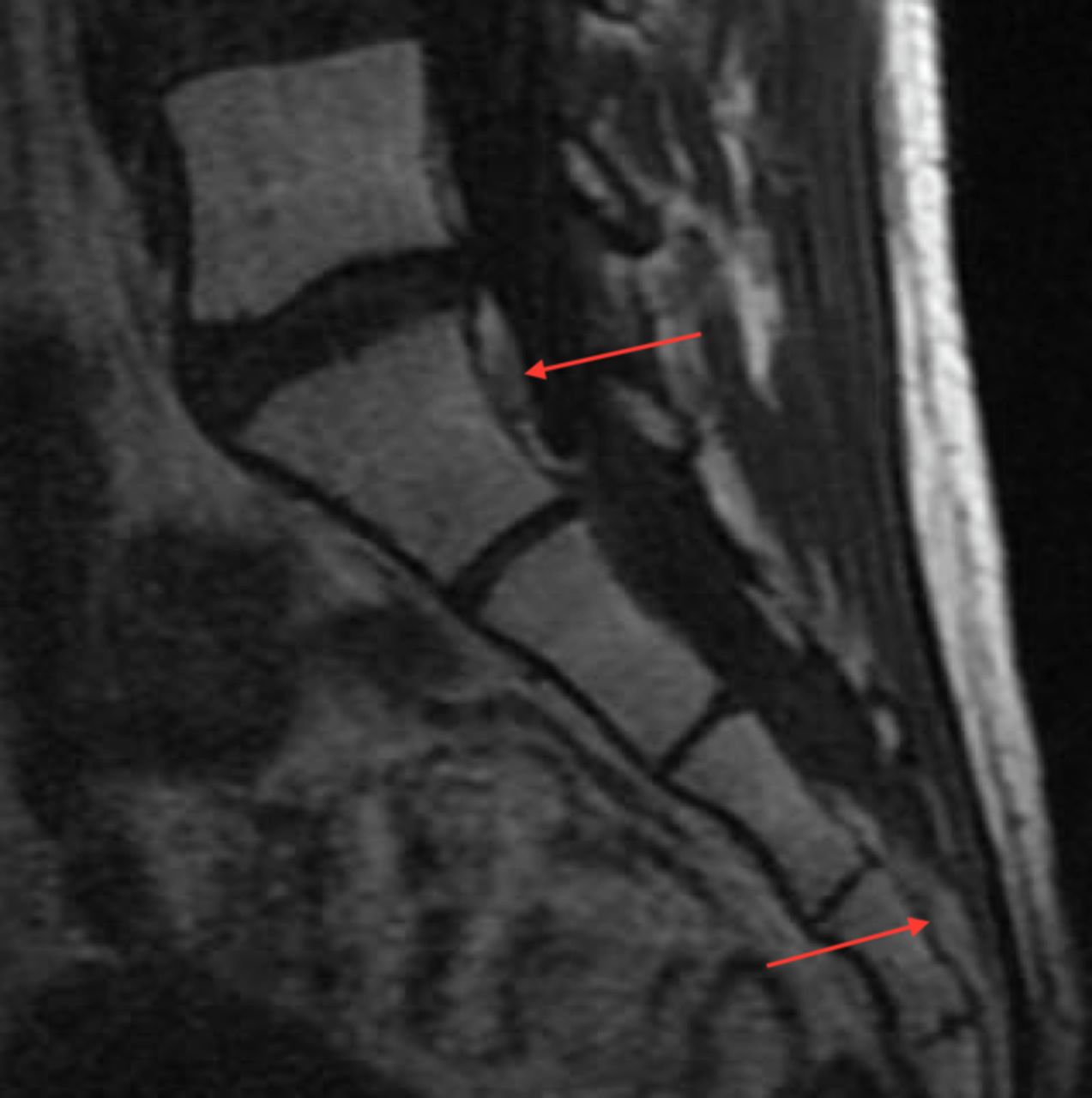 Persistent sacral chloroma in refractory acute myelogenous leukaemia ...